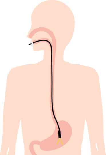 Gastroskopia — jak przebiega i co należy o niej wiedzieć